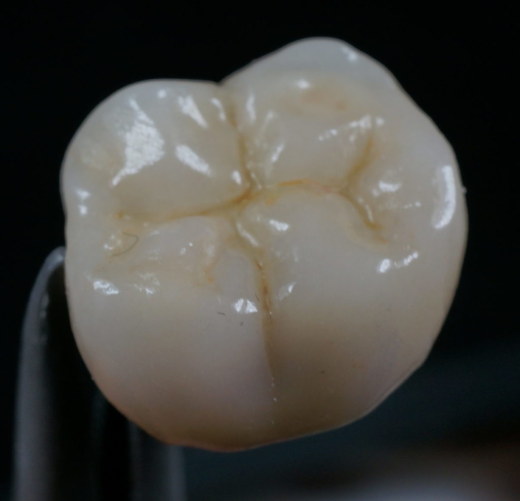 Coronas de Metal Porcelana – Ceramco 3 – Naturaleza Dental Lab